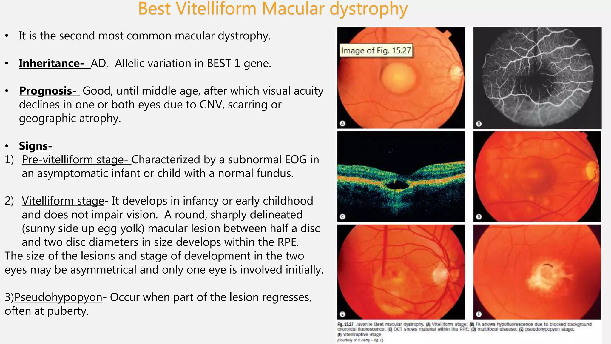 Retinal dystrophy | PPTX