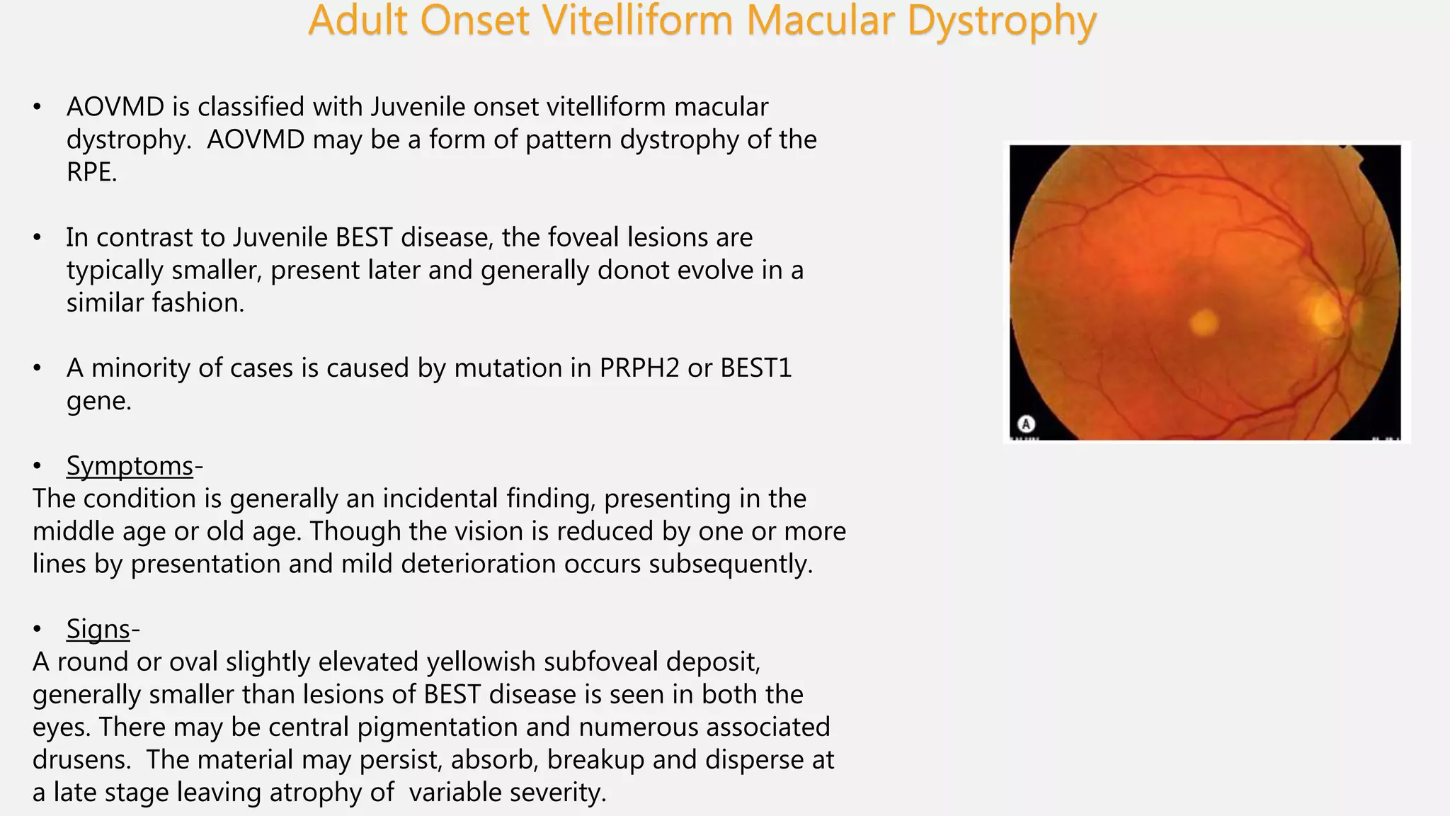 Retinal dystrophy | PPTX