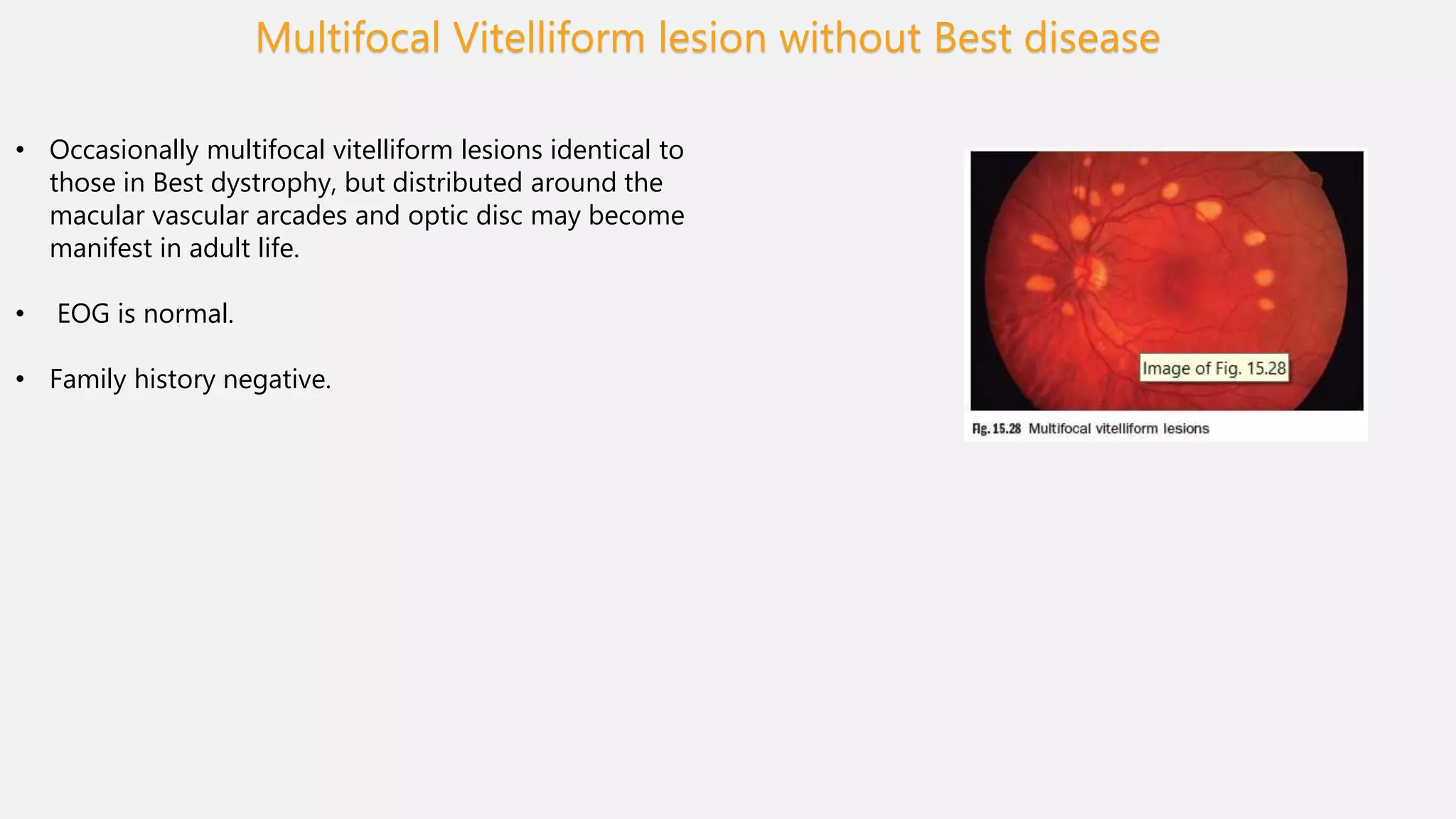 Retinal dystrophy | PPTX