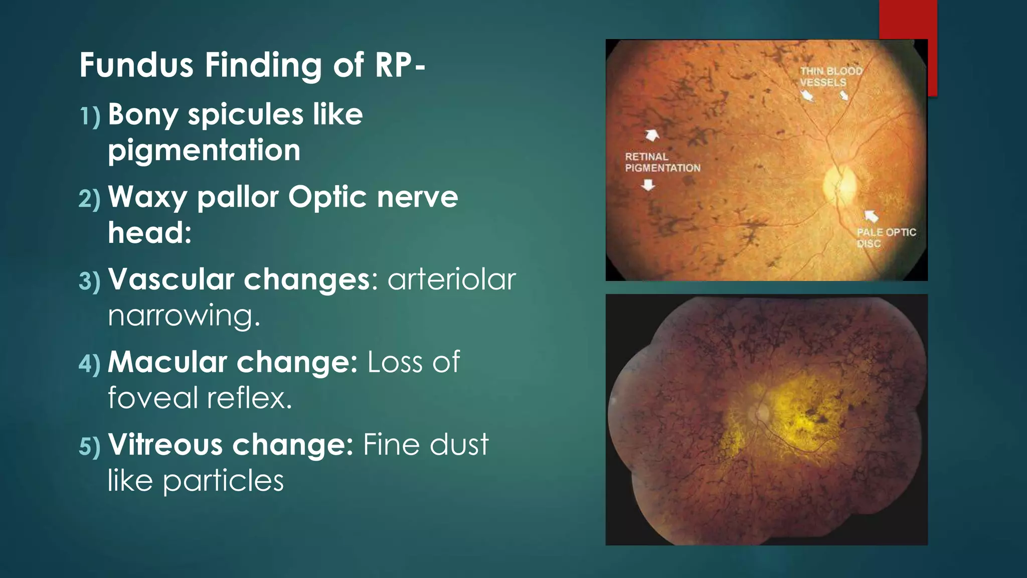 Retinal Dystrophy. Farhad - Copy.pptx | Eye and Vision Conditions ...