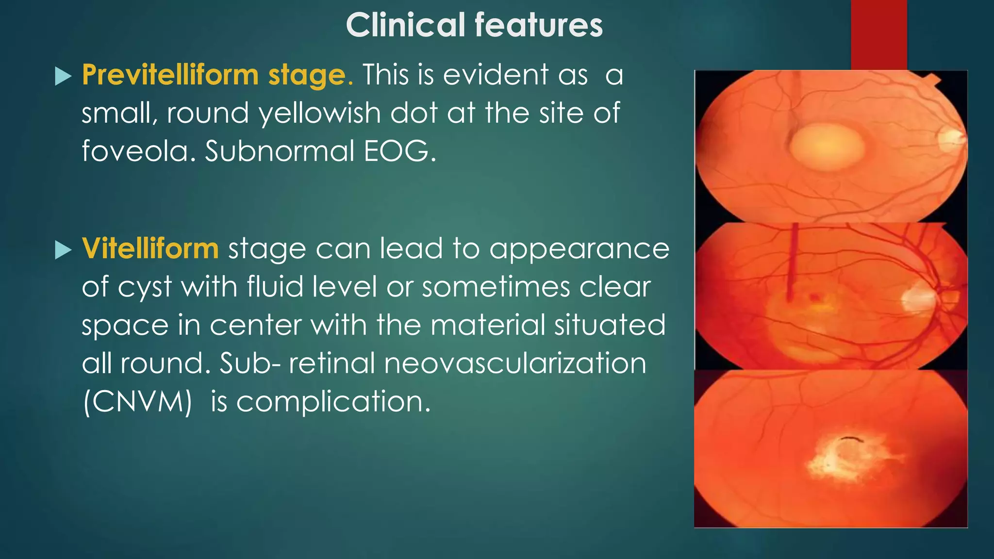 Retinal Dystrophy. Farhad - Copy.pptx | Eye and Vision Conditions ...