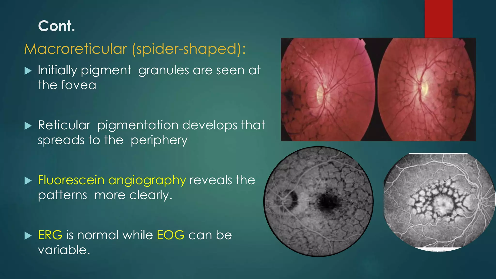 Retinal Dystrophy. Farhad - Copy.pptx