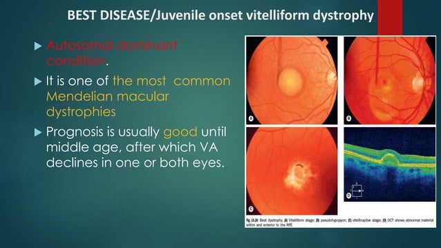 Retinal Dystrophy. Farhad - Copy.pptx | Eye and Vision Conditions ...