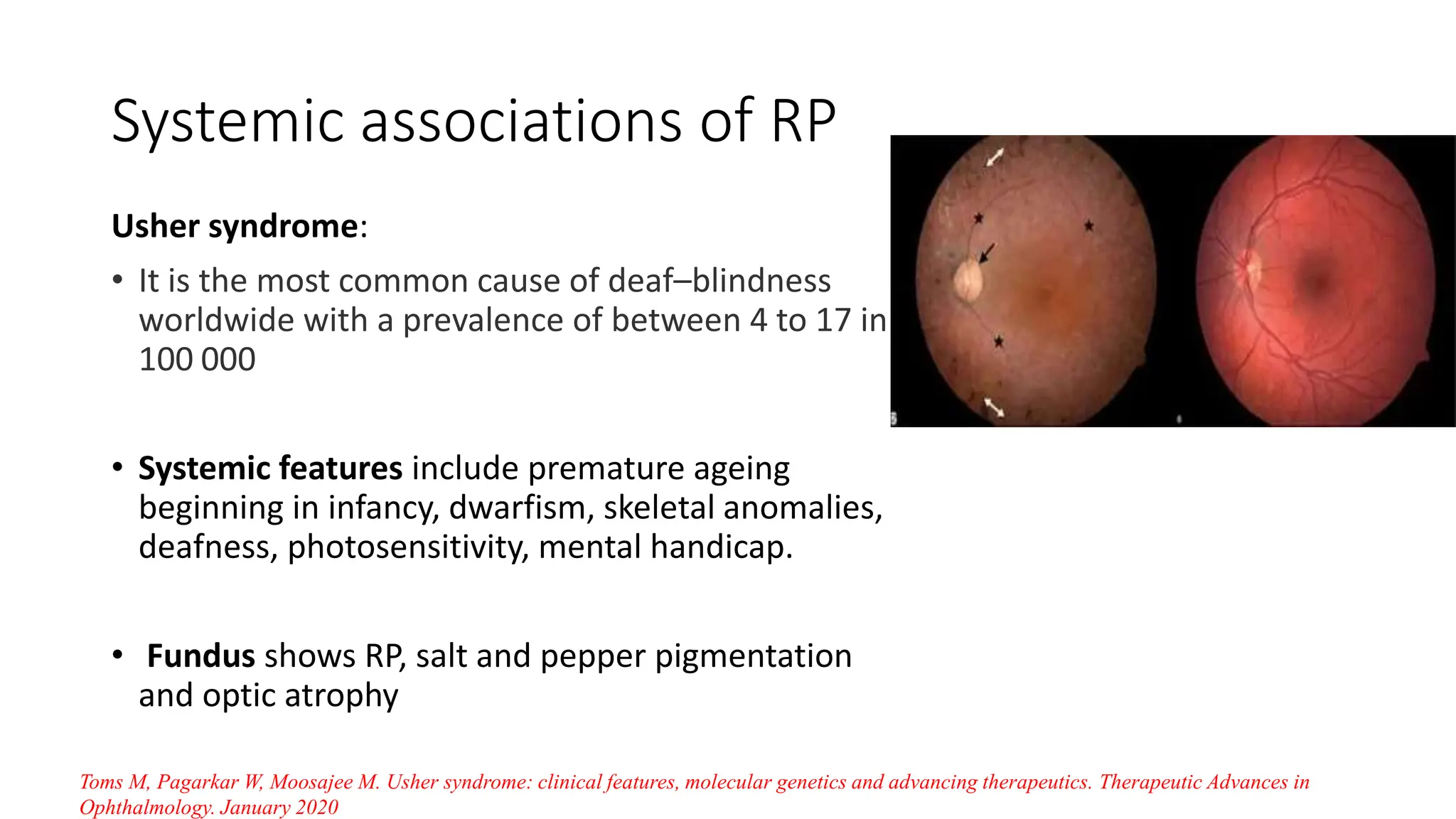 Retinal Dystrophy.pptx vvvvvvvvvvvvvvvvv | PPT