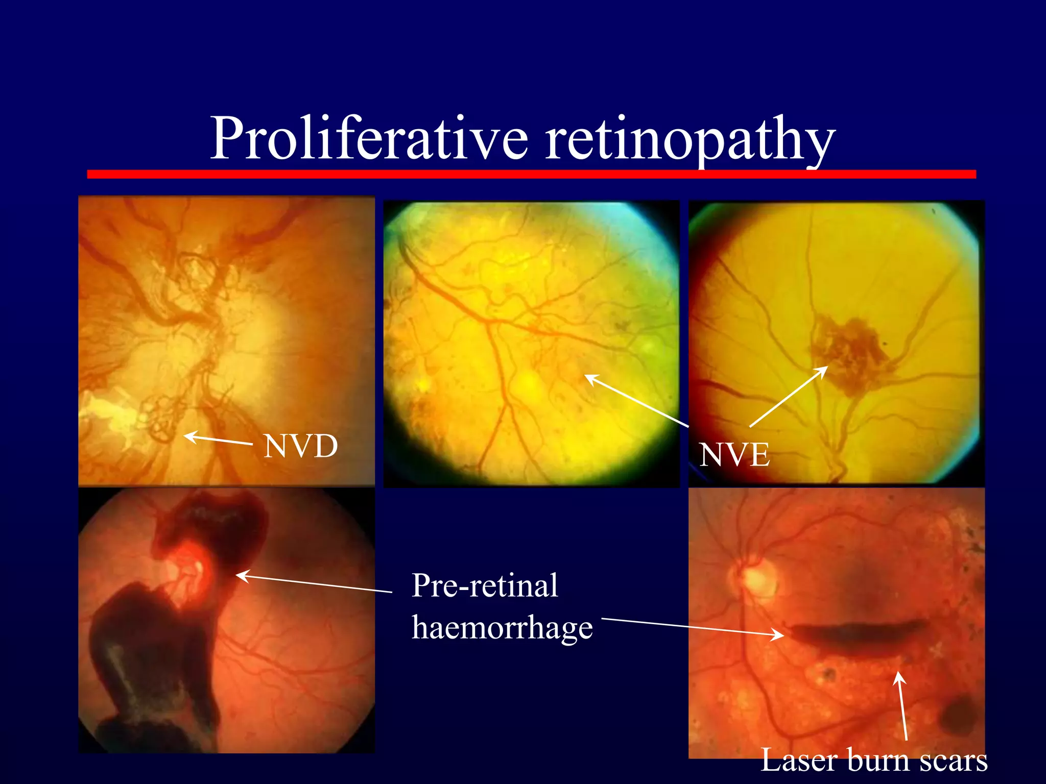 RETINA LECTURE2.ppt