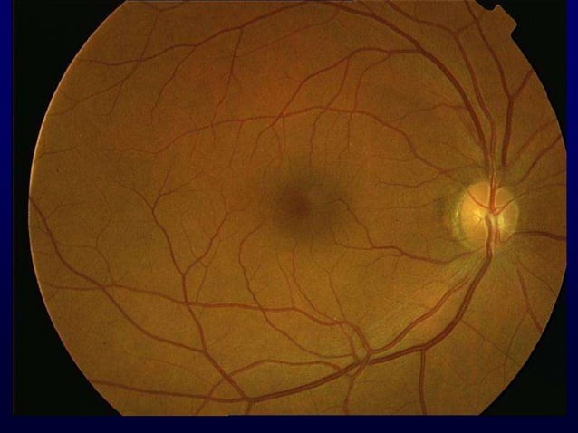 RETINA LECTURE2.ppt