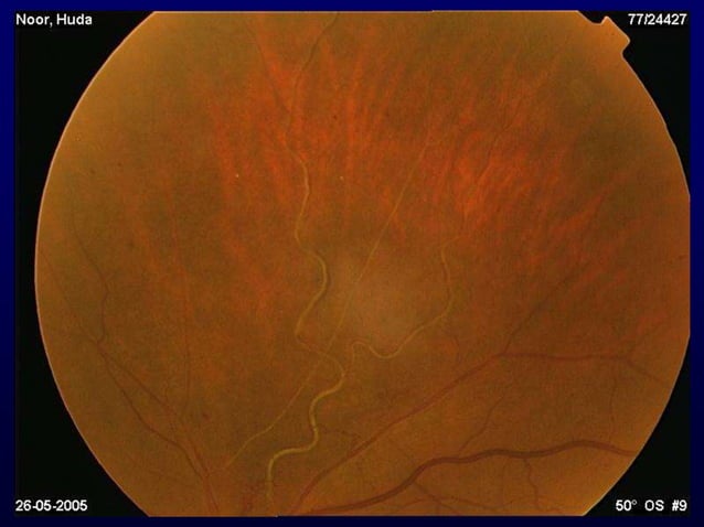 RETINA LECTURE2.ppt