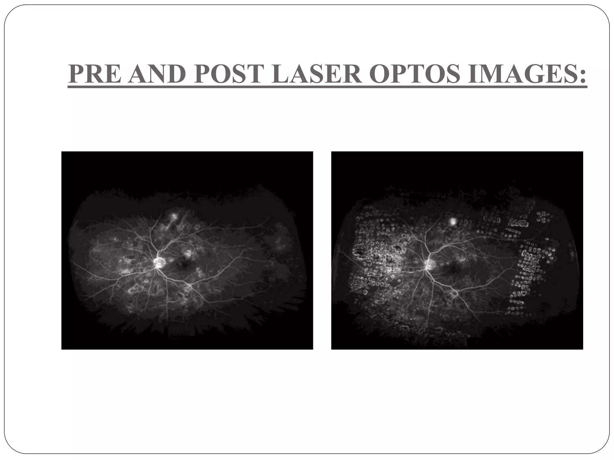 Retinal imaging | PPTX