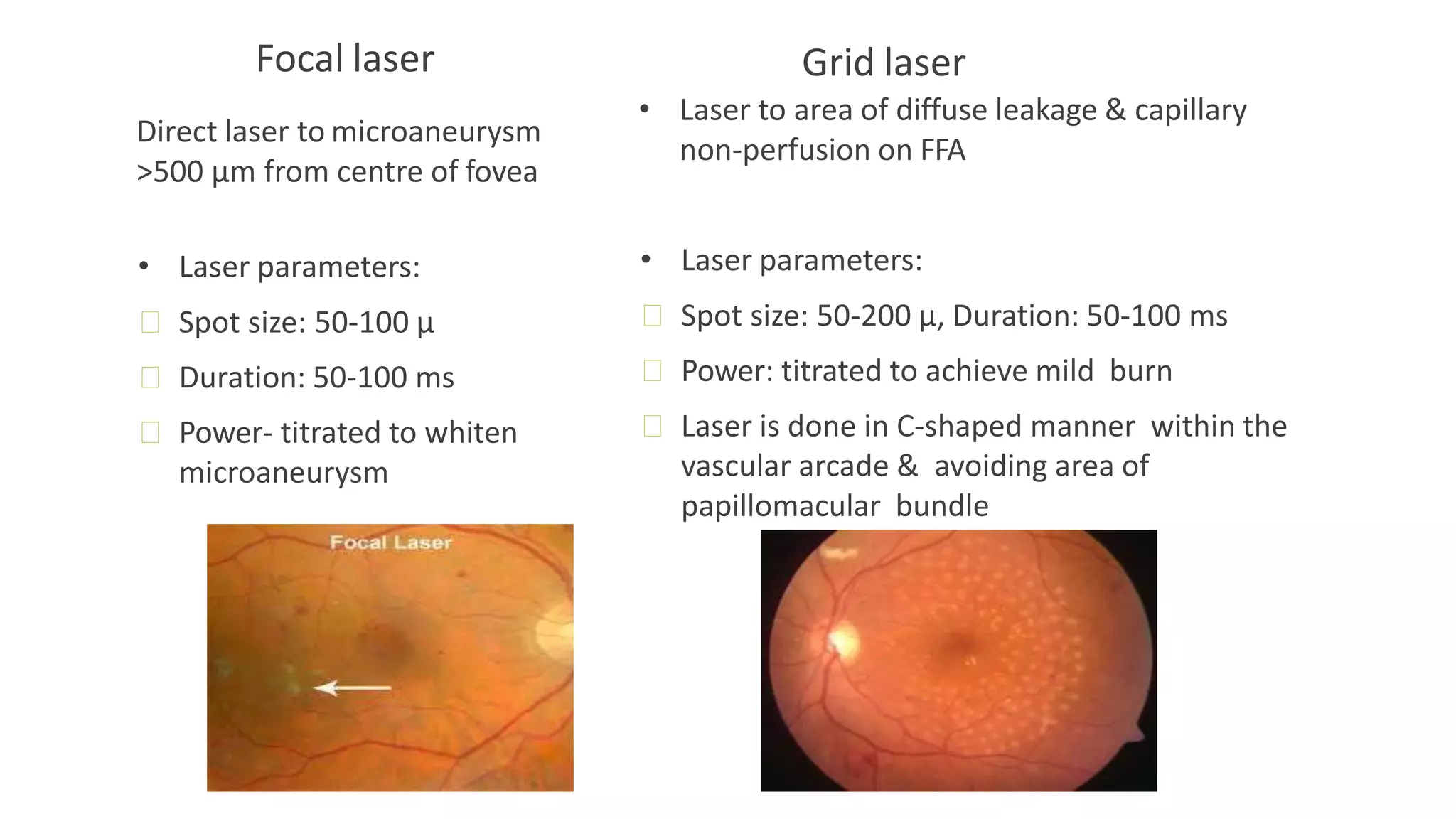 Retinal laser therapy | PPTX