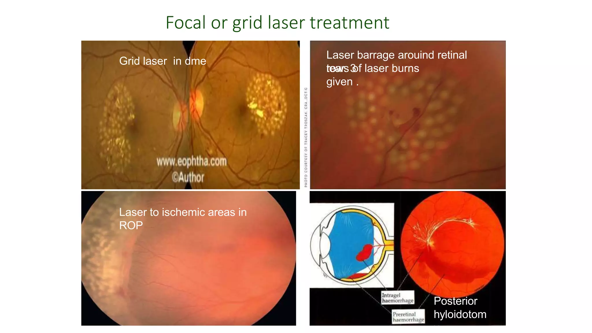 Retinal laser therapy | PPTX