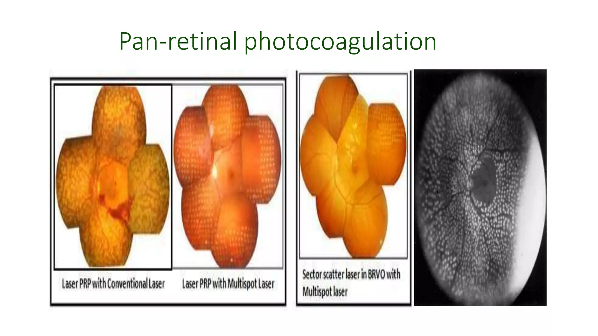 Retinal laser therapy | PPTX