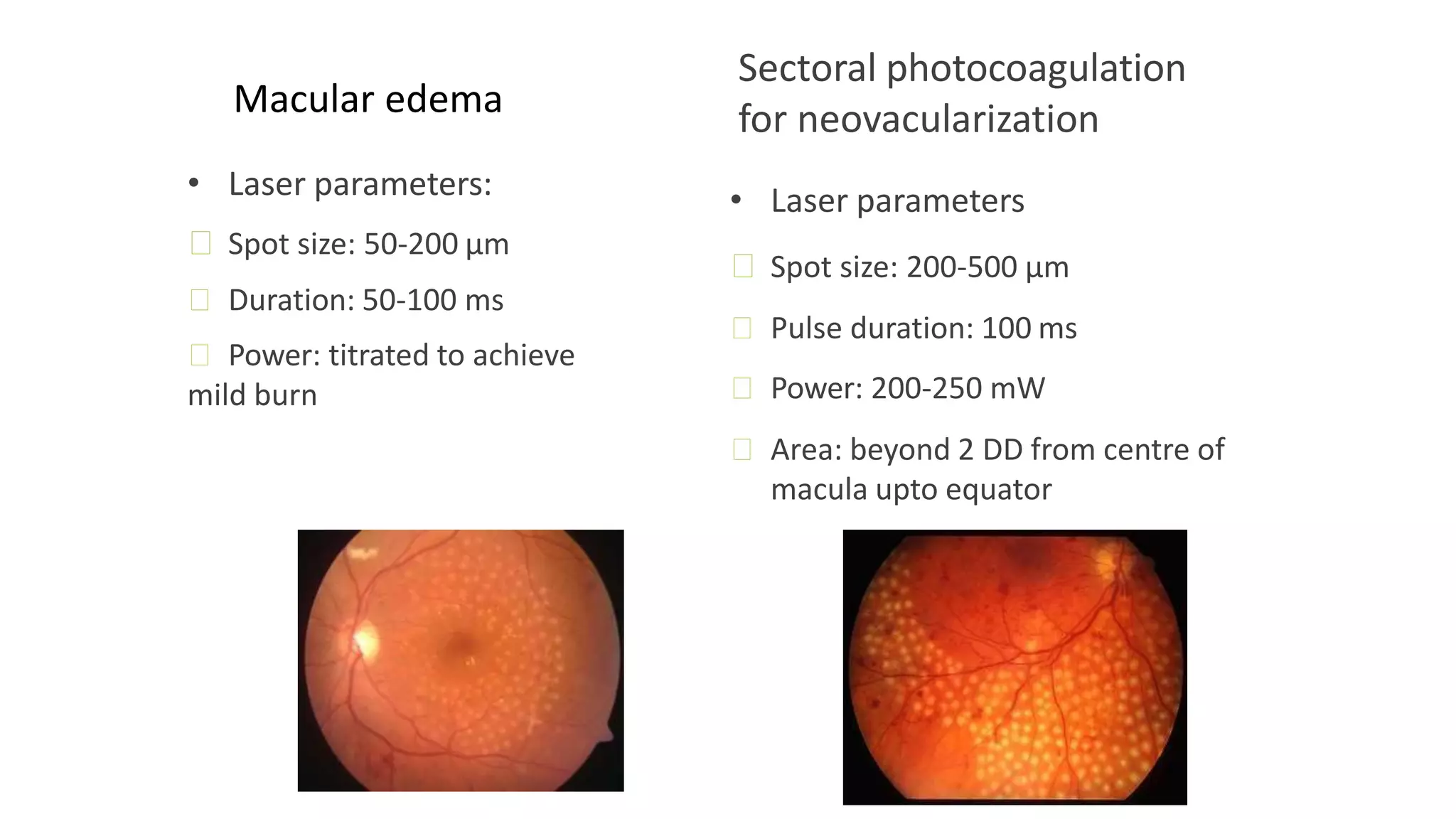 Retinal laser therapy | PPTX