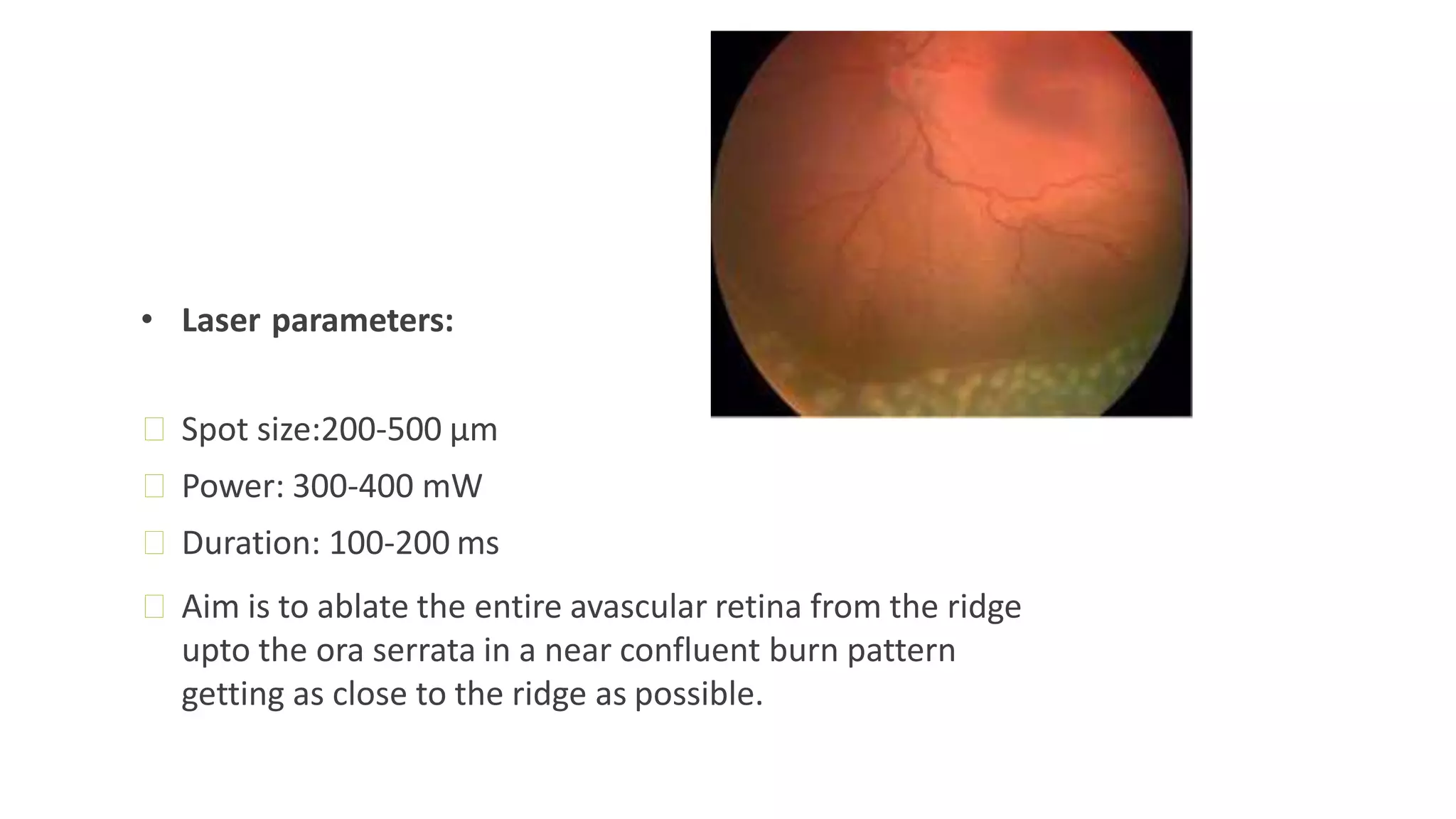 Retinal laser therapy | PPTX