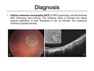 Retinal pigmented fundus | PDF