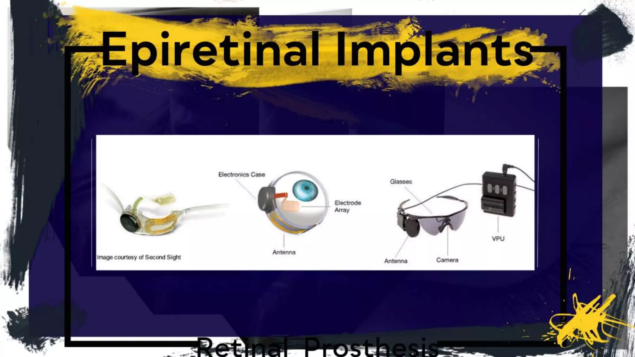 Retinal prosthesis | PPT