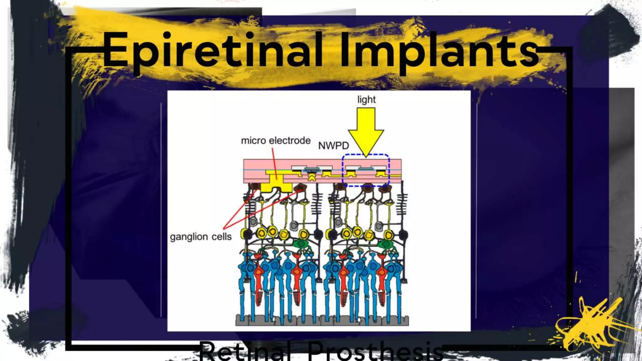 Retinal prosthesis | PPT