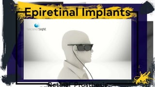 Retinal prosthesis | PPT