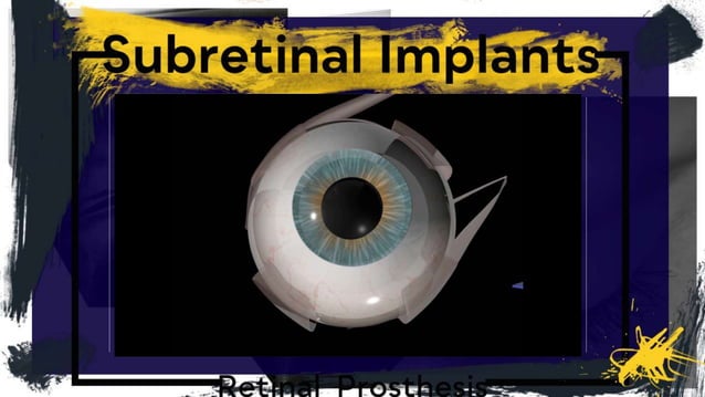 Retinal prosthesis | PPT
