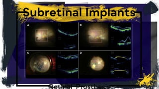 Retinal prosthesis | PPT