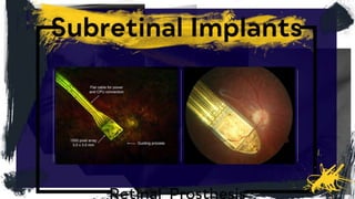 Retinal prosthesis | PPT