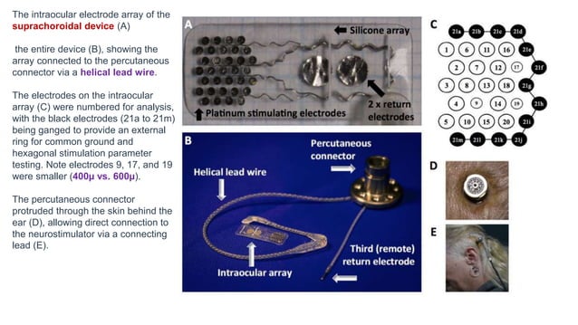Retinal prosthesis | PPTX | Eye and Vision Conditions | Diseases and ...