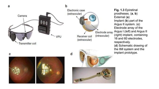 Retinal prosthesis | PPTX | Eye and Vision Conditions | Diseases and ...