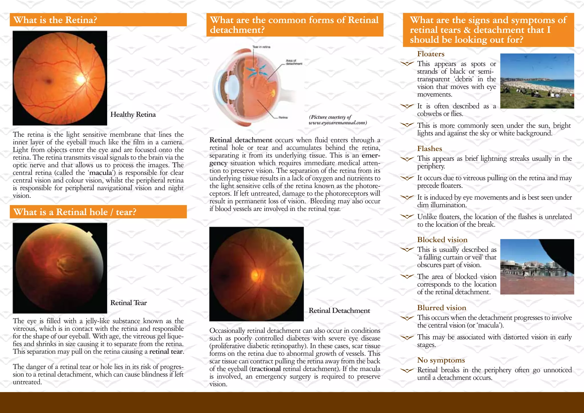 Retinal tears and detachment | PDF