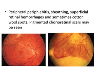 Retinal vascular disease: Diabetic Retinopathy, Branch Retinal Artery ...