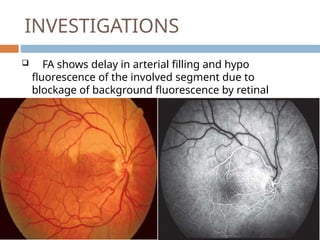 retinal vascular occlusions crvo brvoppt | PPTX