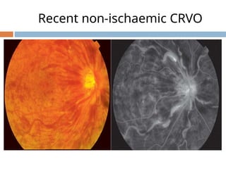 retinal vascular occlusions crvo brvoppt | PPTX