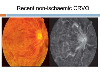 Retinal vascular occlusions | PPTX