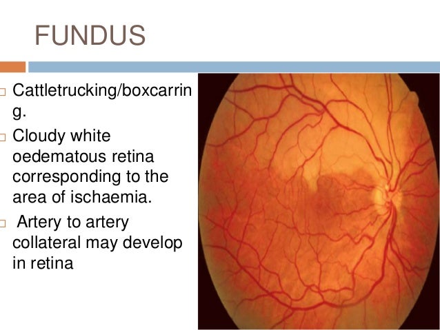 Retinal vascular occlusions
