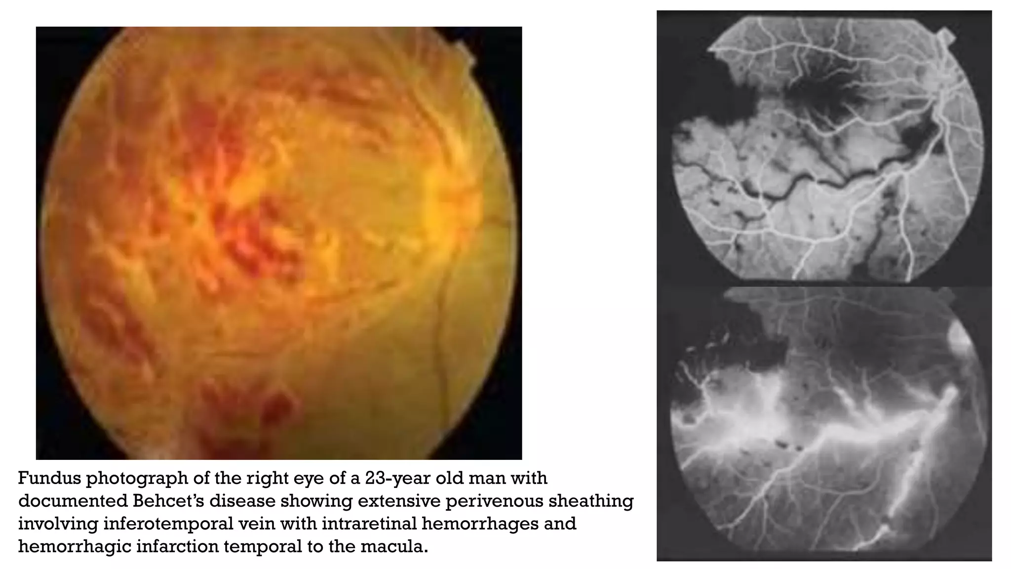 Retinal Vasculitis | PDF | Eye and Vision Conditions | Diseases and ...