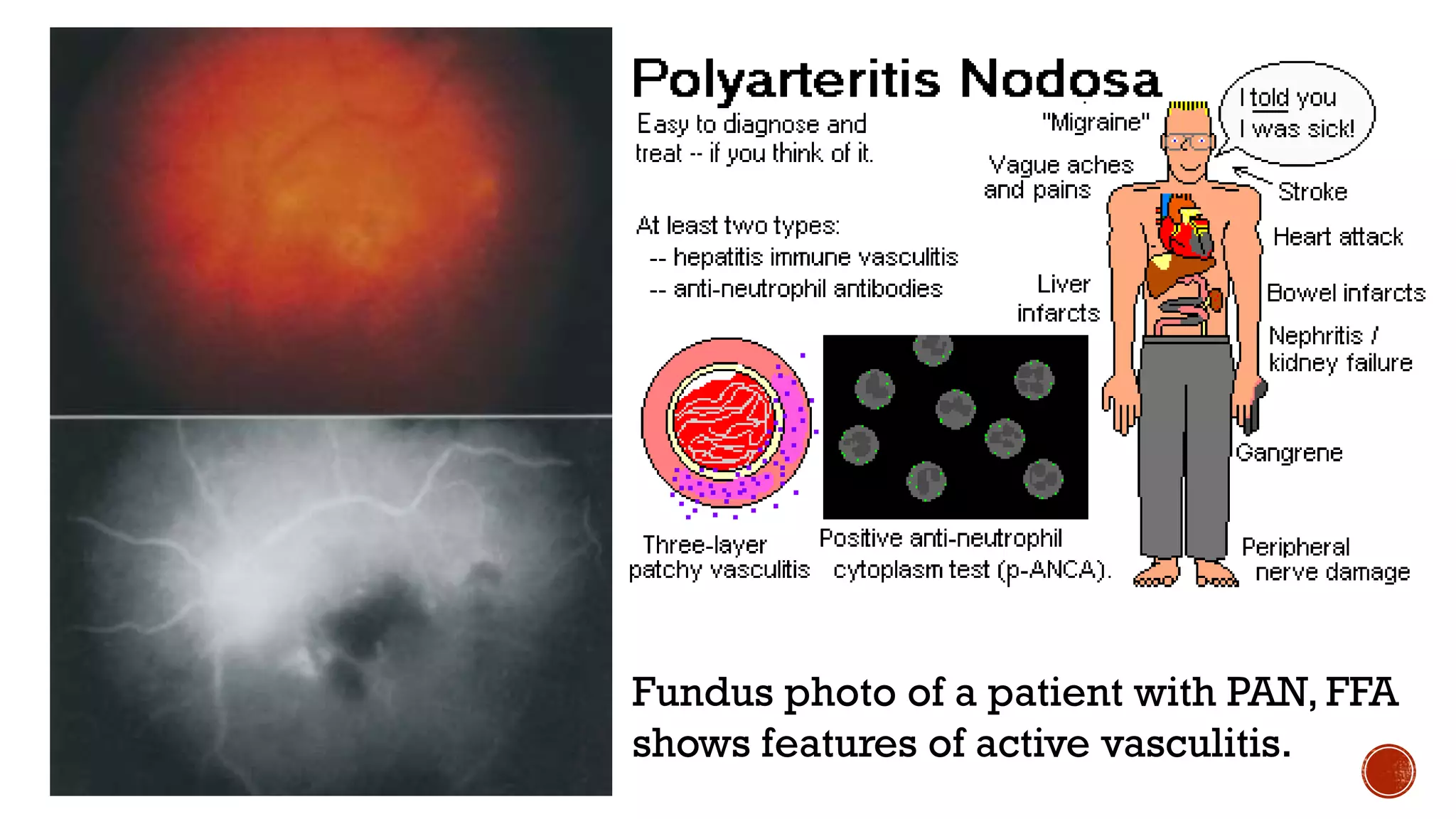 Retinal Vasculitis | PDF