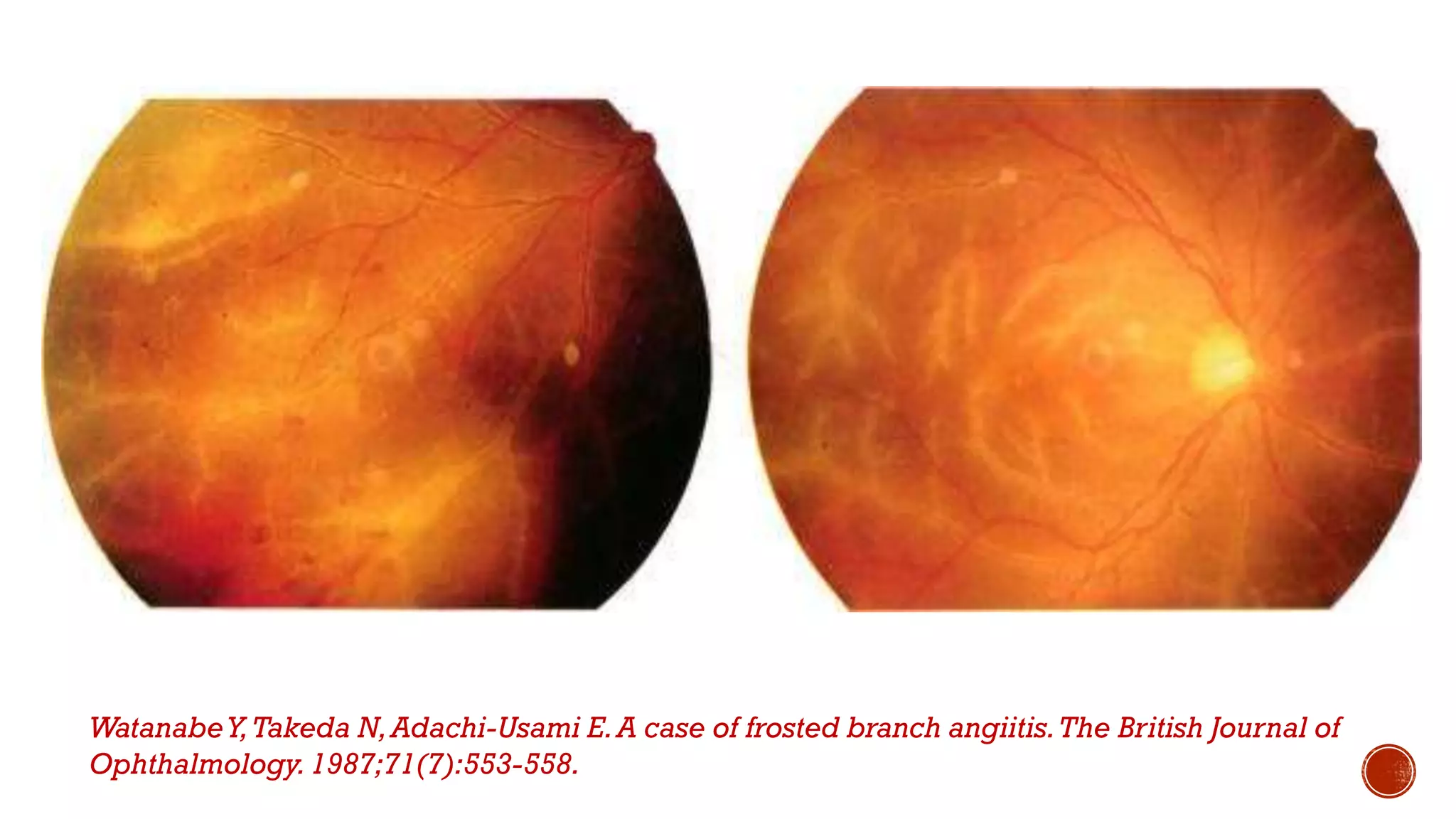 Retinal Vasculitis | PDF