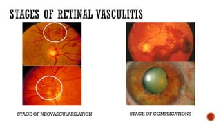 Retinal Vasculitis
