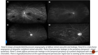 retinal vasculitis final clinical presentation | PPTX