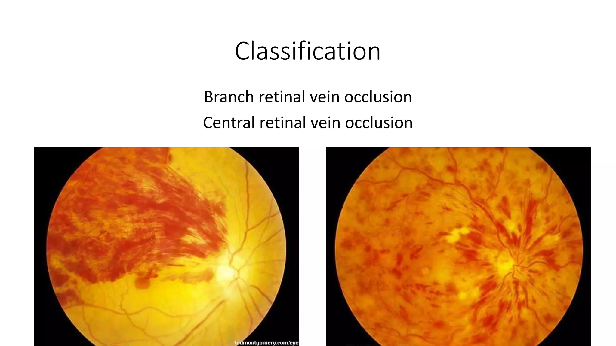 Retinal vein occlusion | PPTX