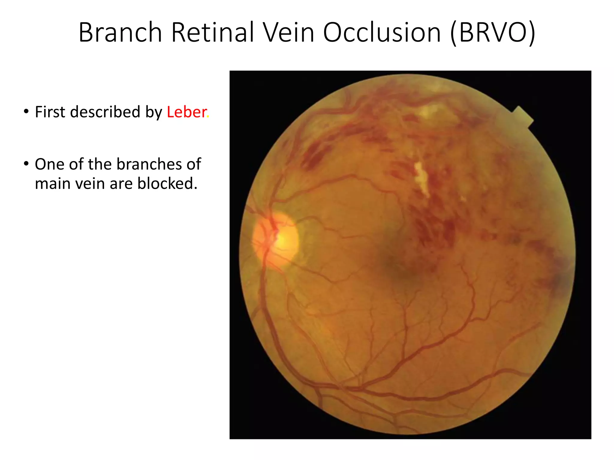 Retinal vein occlusion | PPTX