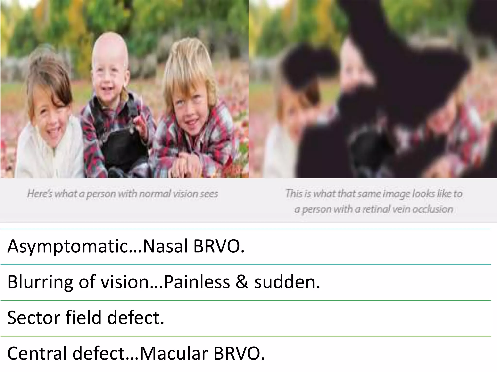 Retinal vein occlusion | PPTX