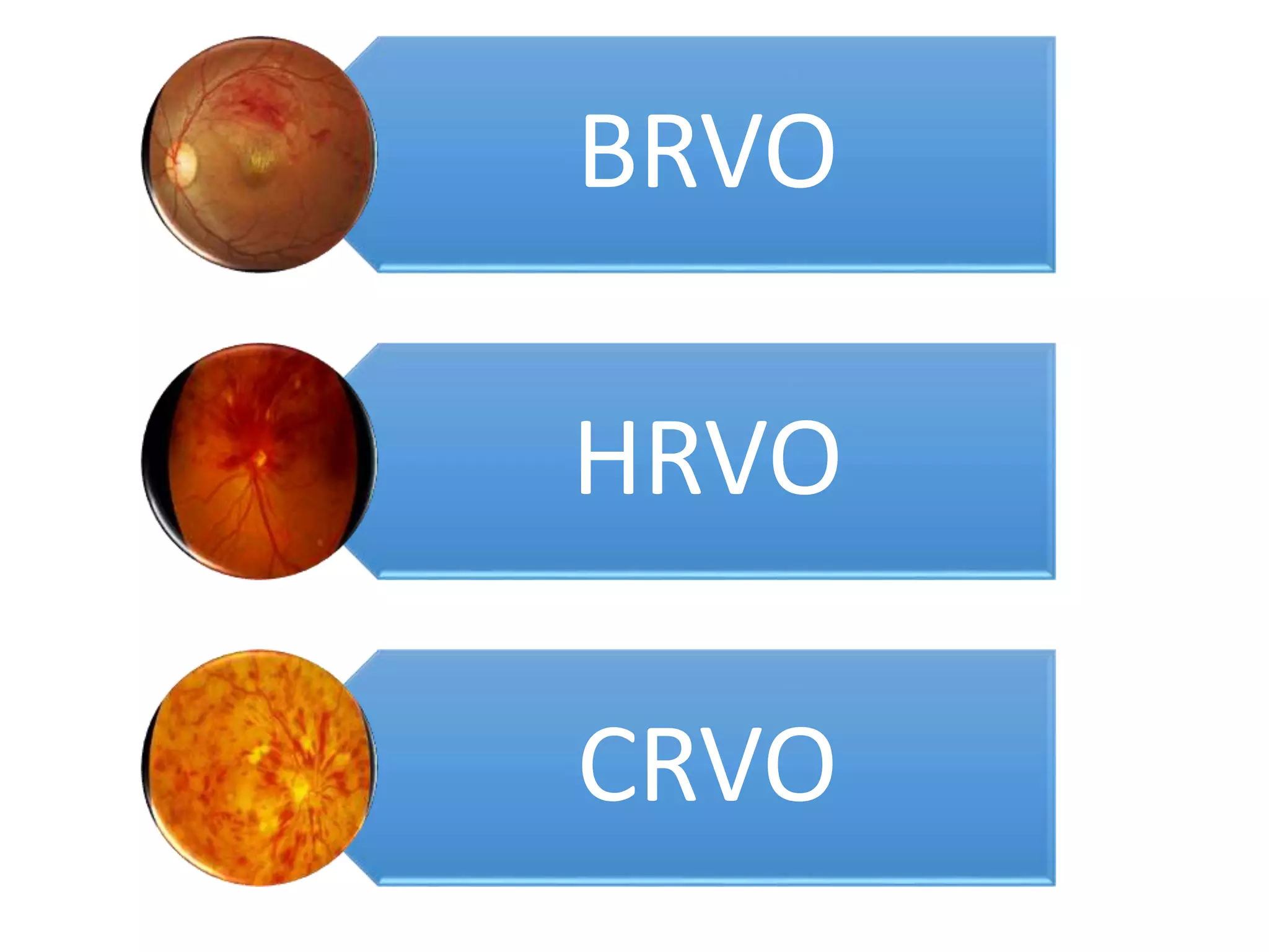 Retinal vein occlusion | PPTX