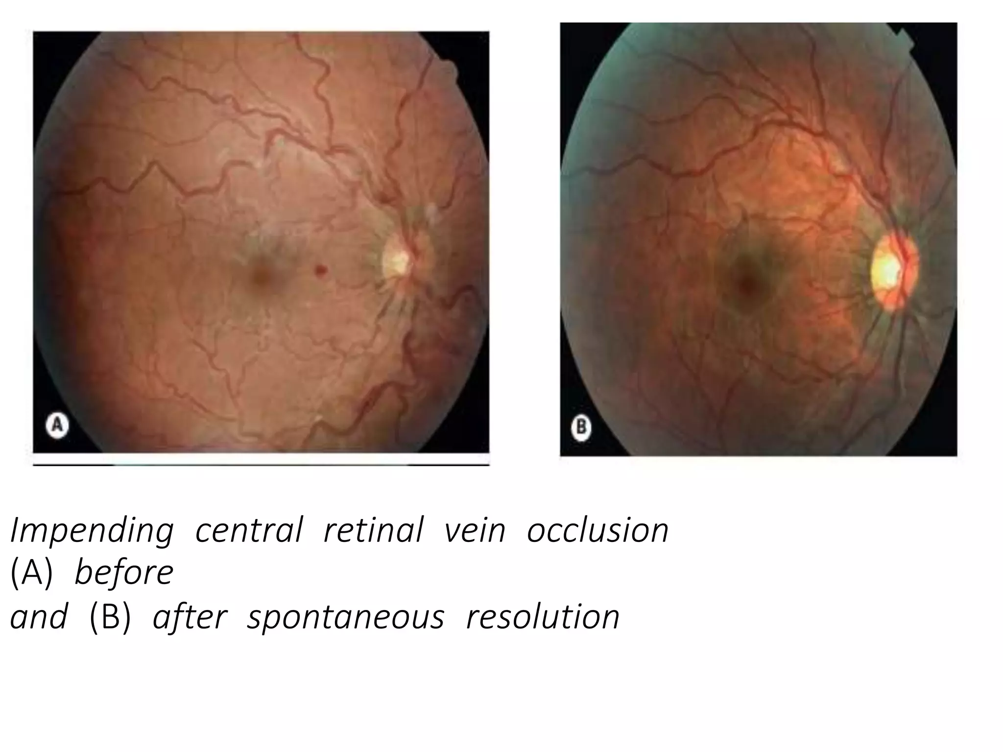 Retinal vein occlusion | PPTX