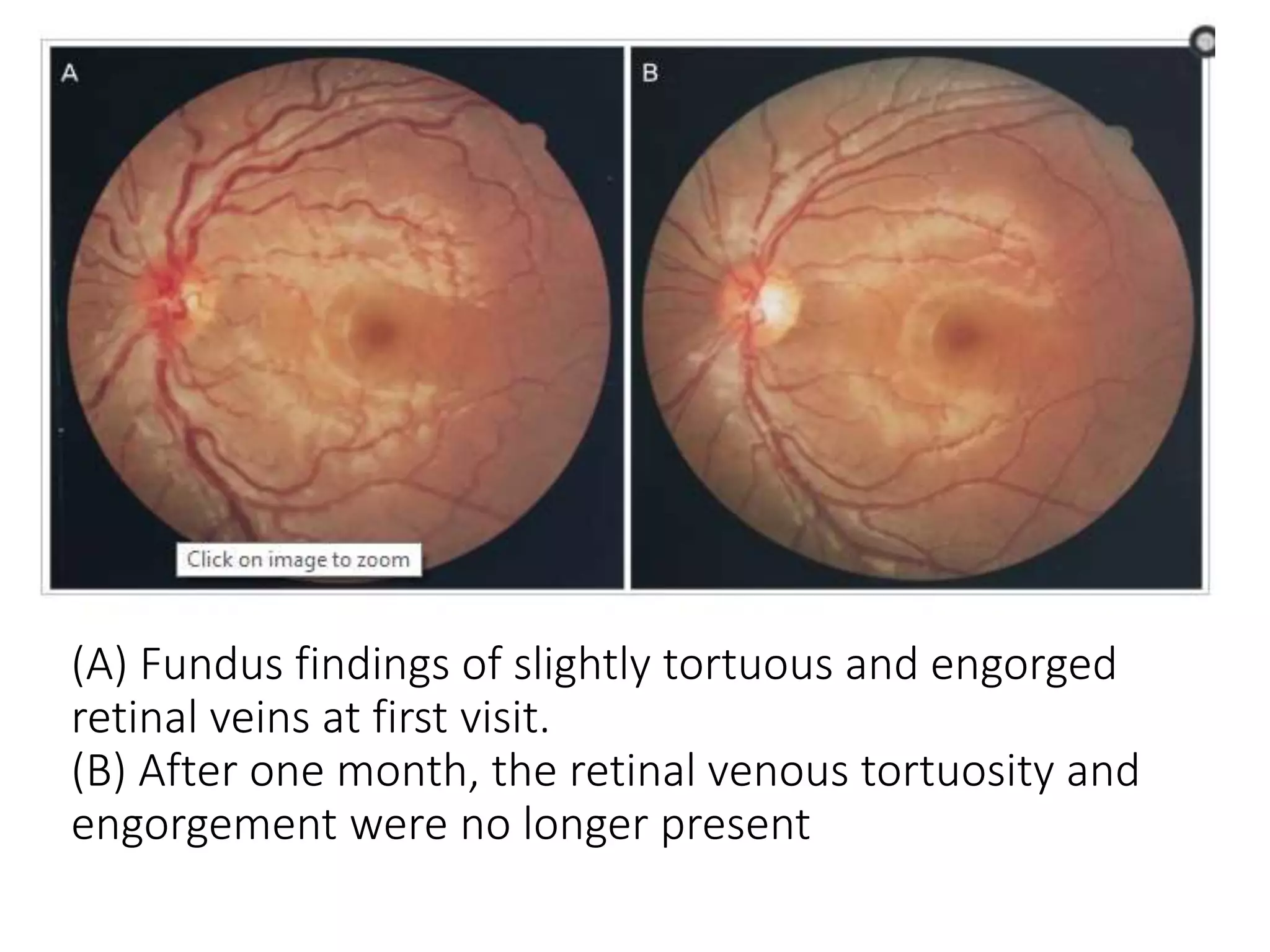 Retinal vein occlusion | PPTX
