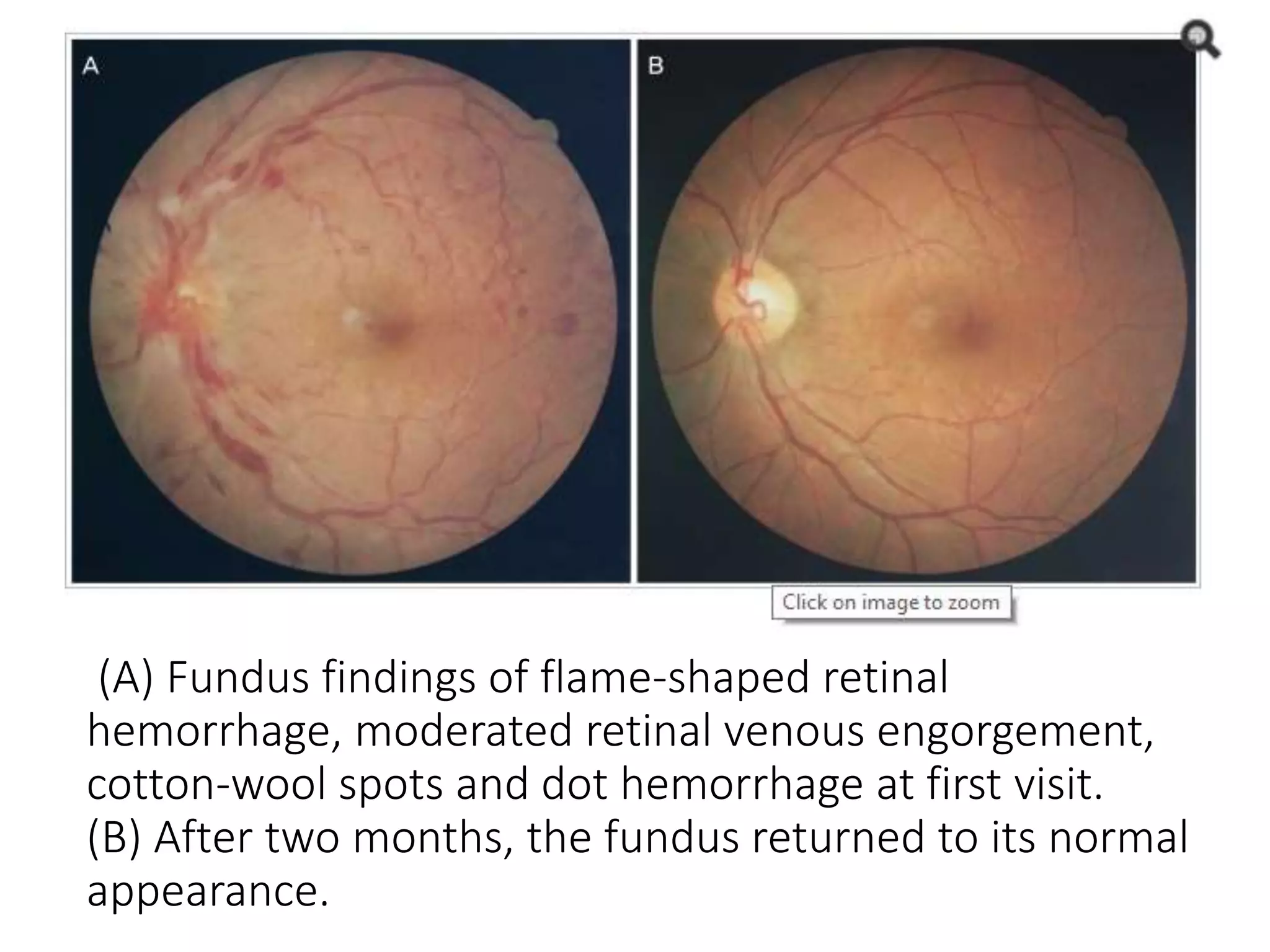 Retinal vein occlusion | PPTX