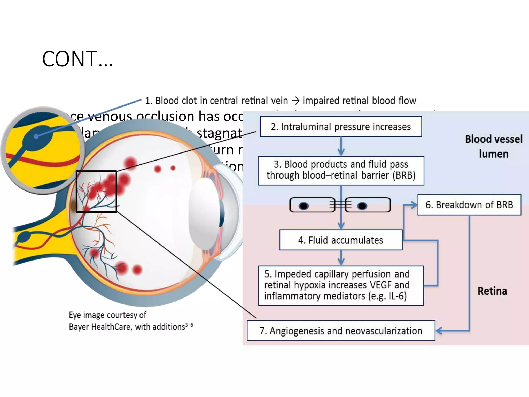 Retinal vein occlusion | PPTX