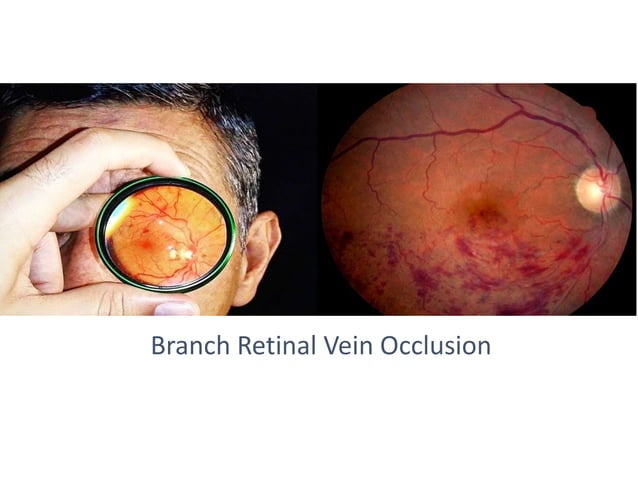 Retinal vein occlusion | PPTX | Eye and Vision Conditions | Diseases ...