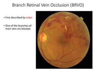 Retinal vein occlusion | PPTX