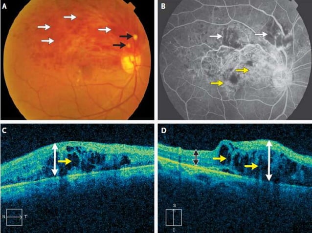 Retinal vein occlusion | PPTX | Eye and Vision Conditions | Diseases ...