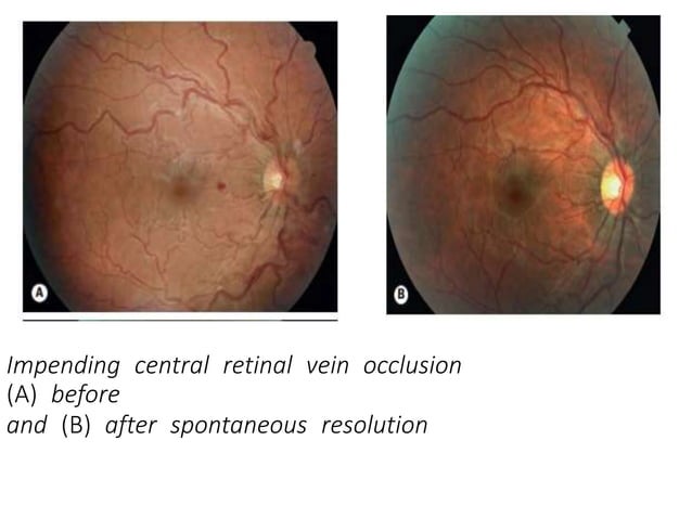Retinal vein occlusion | PPTX | Eye and Vision Conditions | Diseases ...