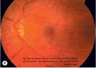 Retinal vein occlusion | PPTX